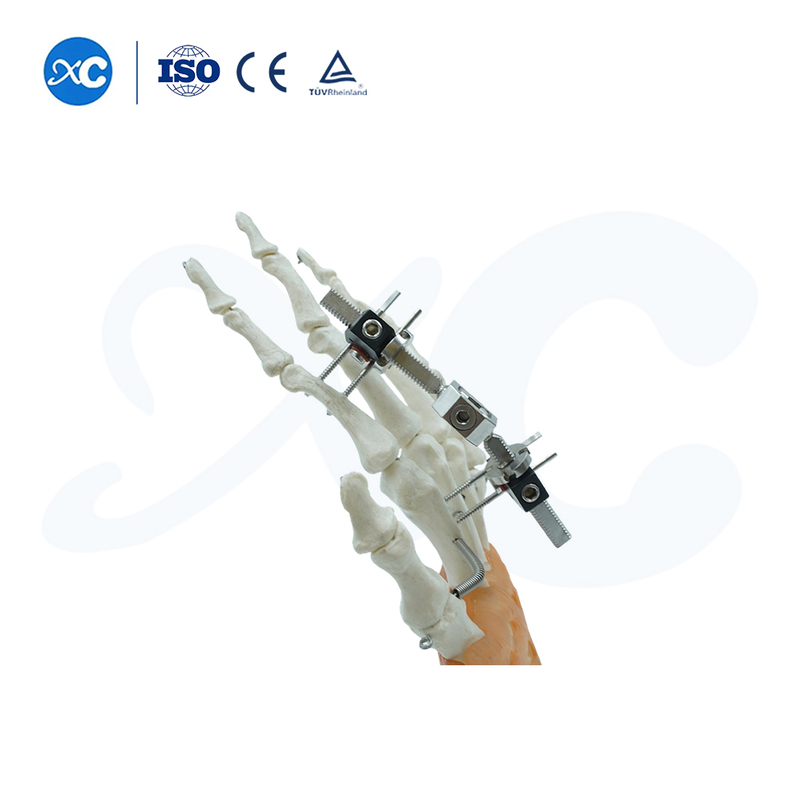External Fixation for Metacarpals And Phalanges - Buy Product on XC Medico