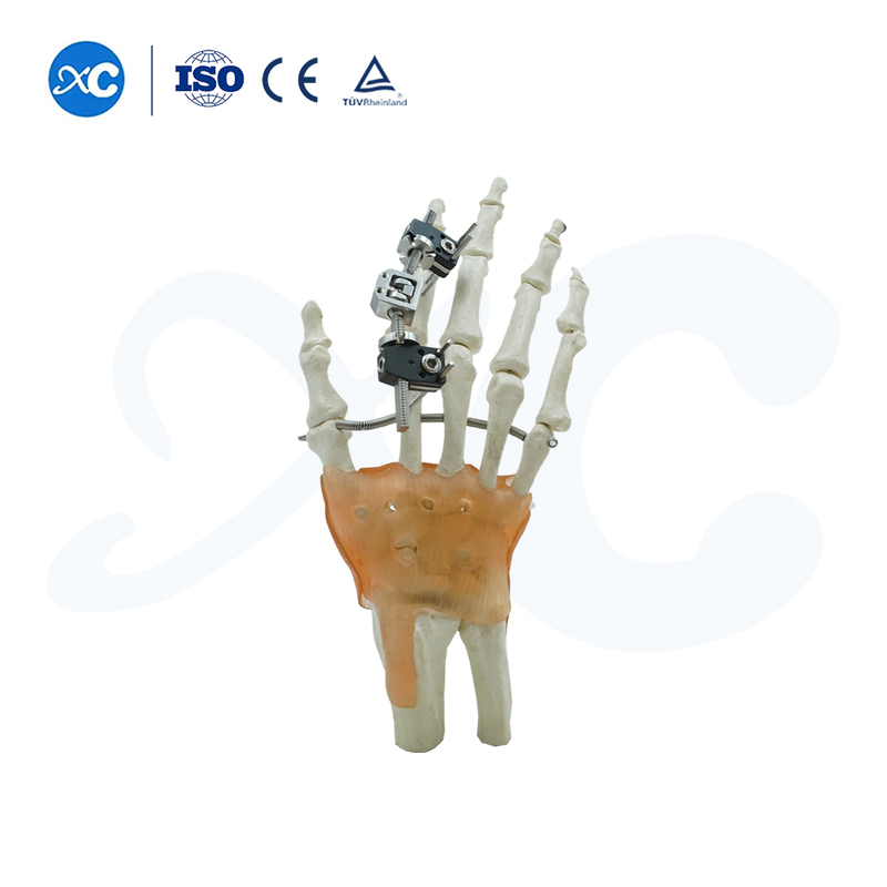 External Fixation for Metacarpals And Phalanges - Buy Product on XC Medico