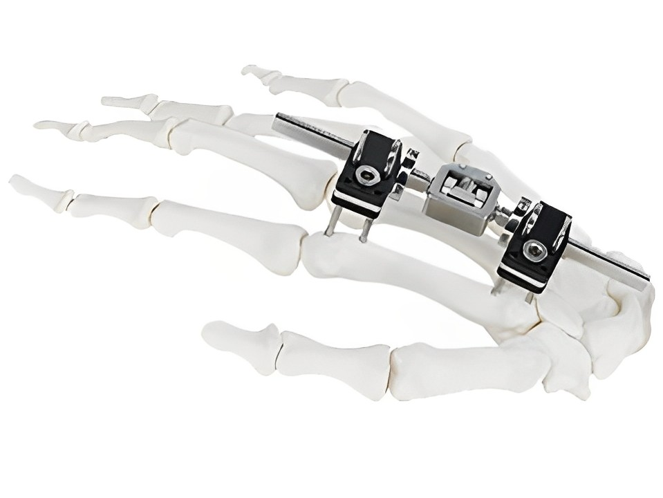 2025 External Fixator Manufacturers: The "Unsung Heroes" of the Medical ...